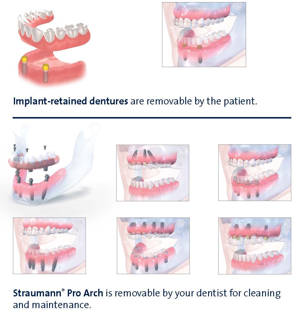 Teeth-in-an-Hour La Jolla CA | Dental Implants San Diego