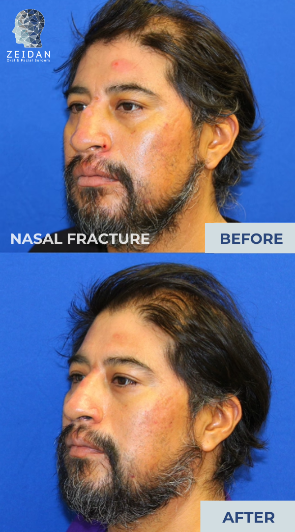 Facial Trauma La Jolla CA | Facial Injury | Facial Fracture San Diego